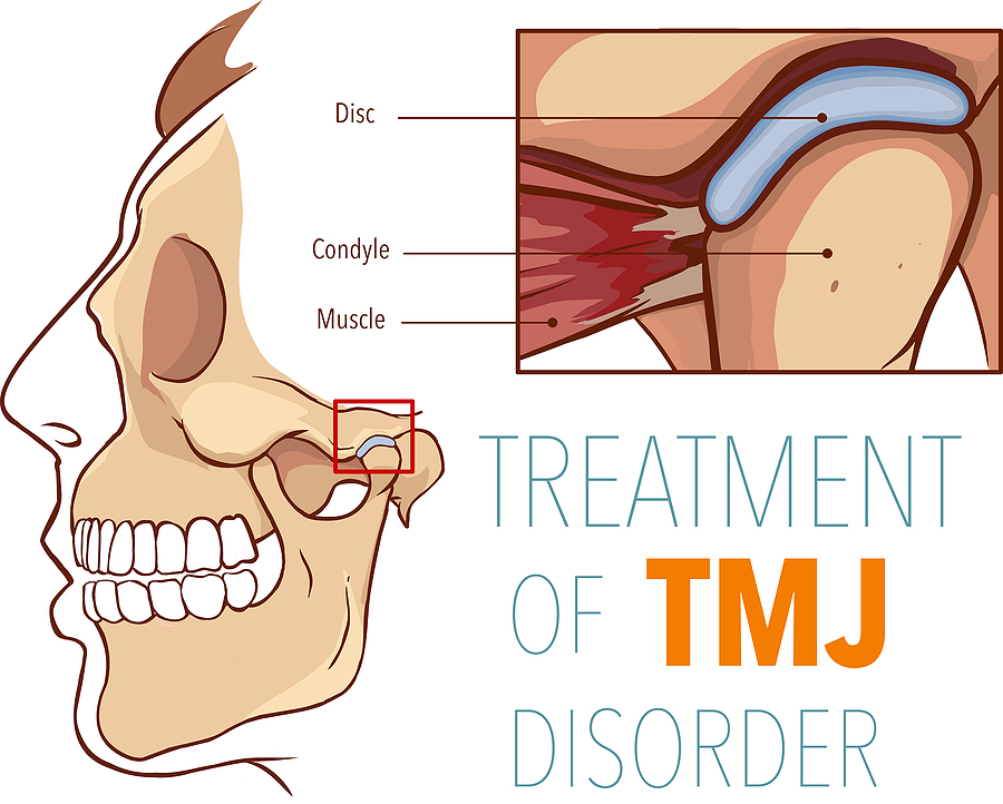 Understanding TMJ-TMD: Causes, Symptoms, and Treatment Options in Brooklyn and New York, NY ...