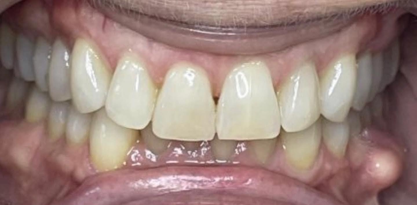 Invisalign Treatment in Santa Clara CA