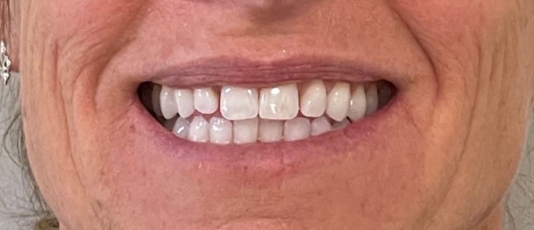 Invisalign Treatment in Santa Clara CA