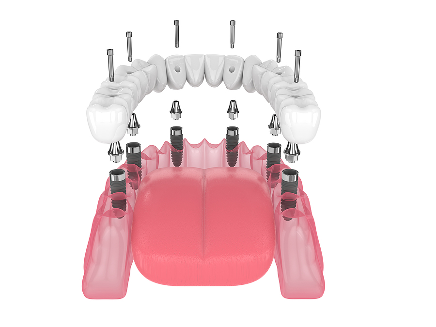 A Complete Guide to All-on-6 Dental Implants in Houston, TX | Galleria ...