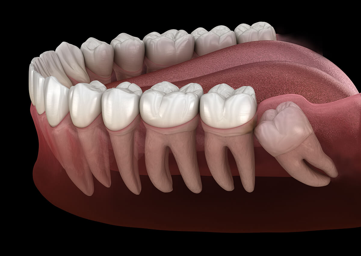 Wisdom Teeth Removal in Clarksville & Pleasant View TN