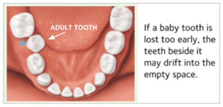 Tooth Decay in Baby Teeth | Rock Kids Dental