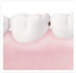 Treating Cavities | Rock Kids Dental Crofton MD