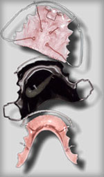 Removable Appliances | Rock Kids Dental Crofton MD