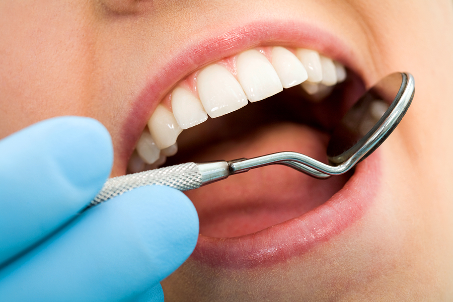 Everything You Need to Know About Fillings/Restorations in Houston, TX ...