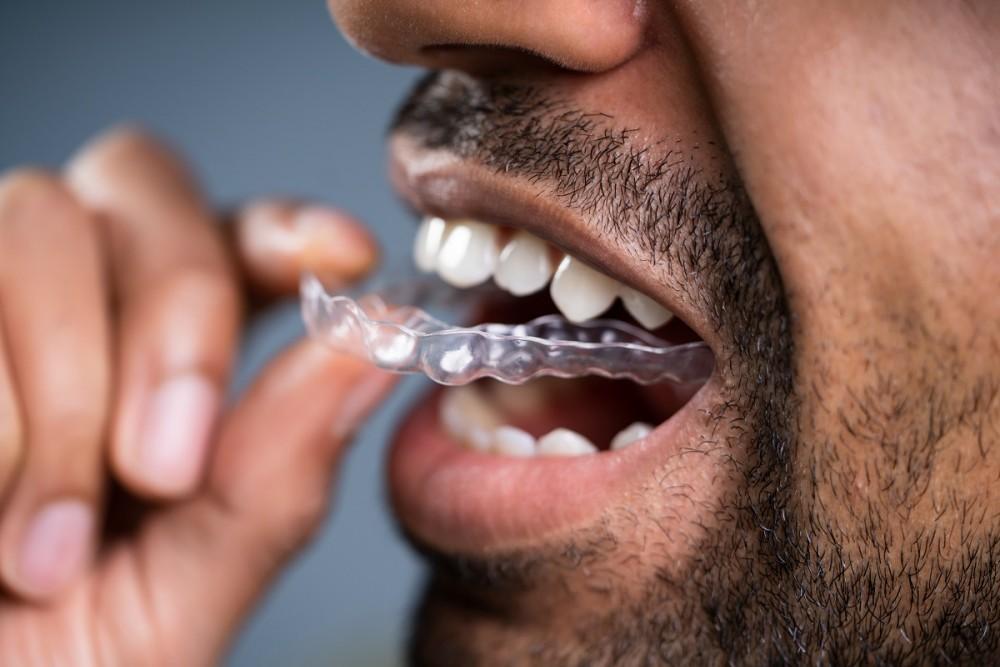 5 Benefits of Invisalign® | RR Dentistry