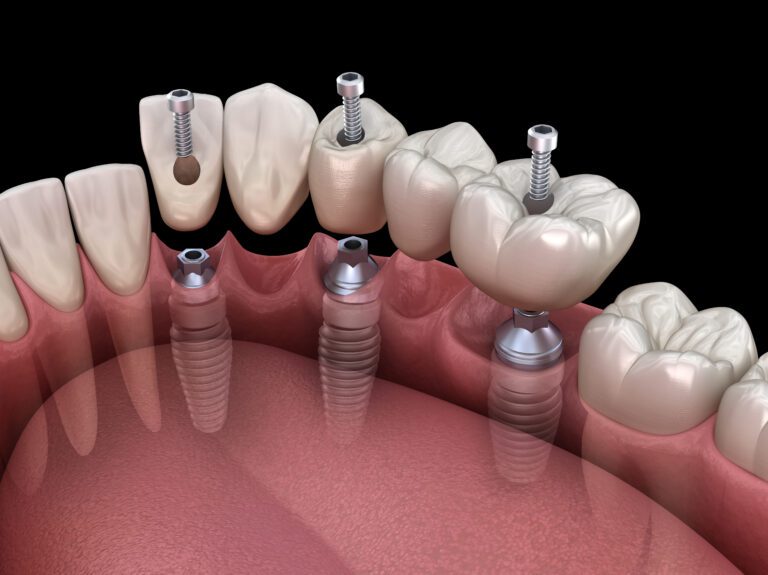 Dental Implant Options in North Hollywood, CA