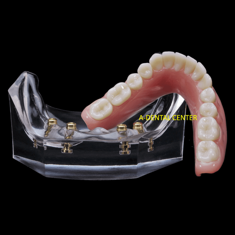 All-on-4 Removable Dentures in North Hollywood, CA