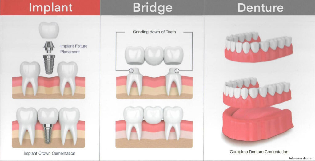 Replacing Your Missing Teeth With Implants | Infinite Smile Dental Inc ...