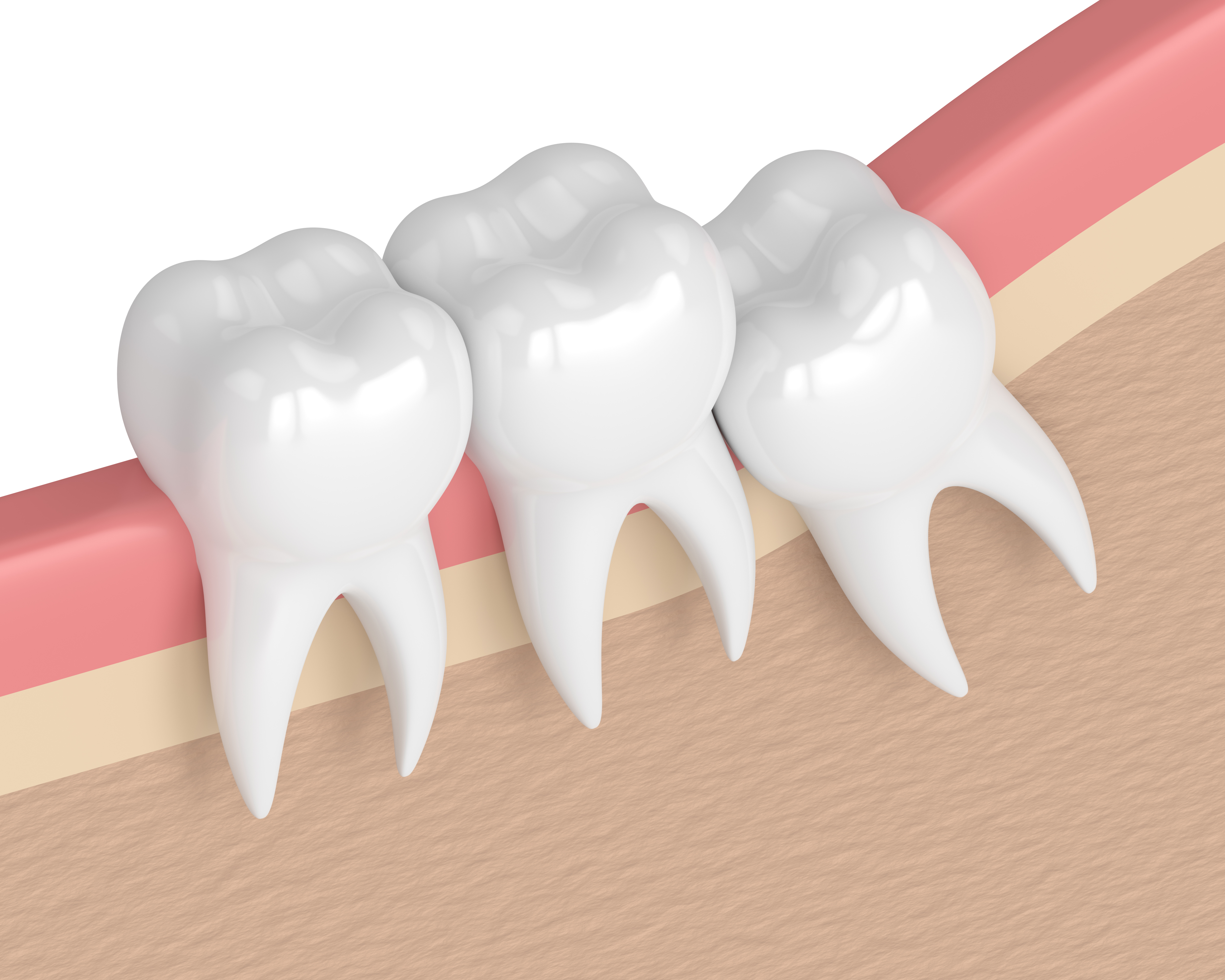Wisdom Tooth Extraction in Suwanee, GA
