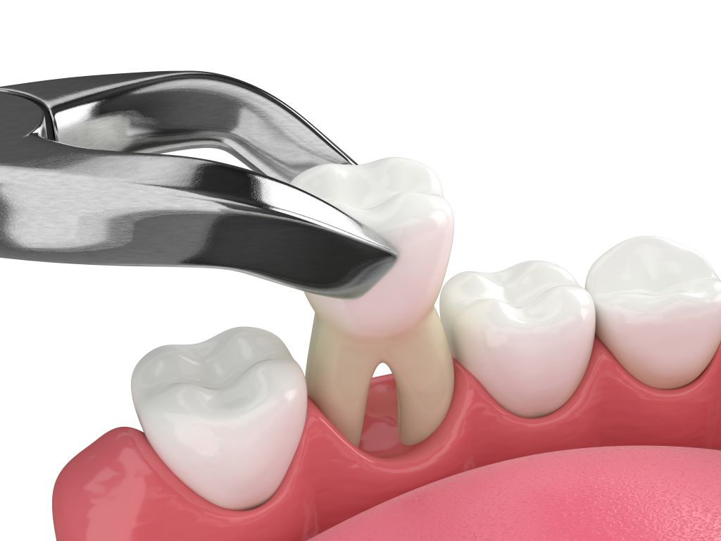 Wisdom Tooth Extraction in Suwanee, GA