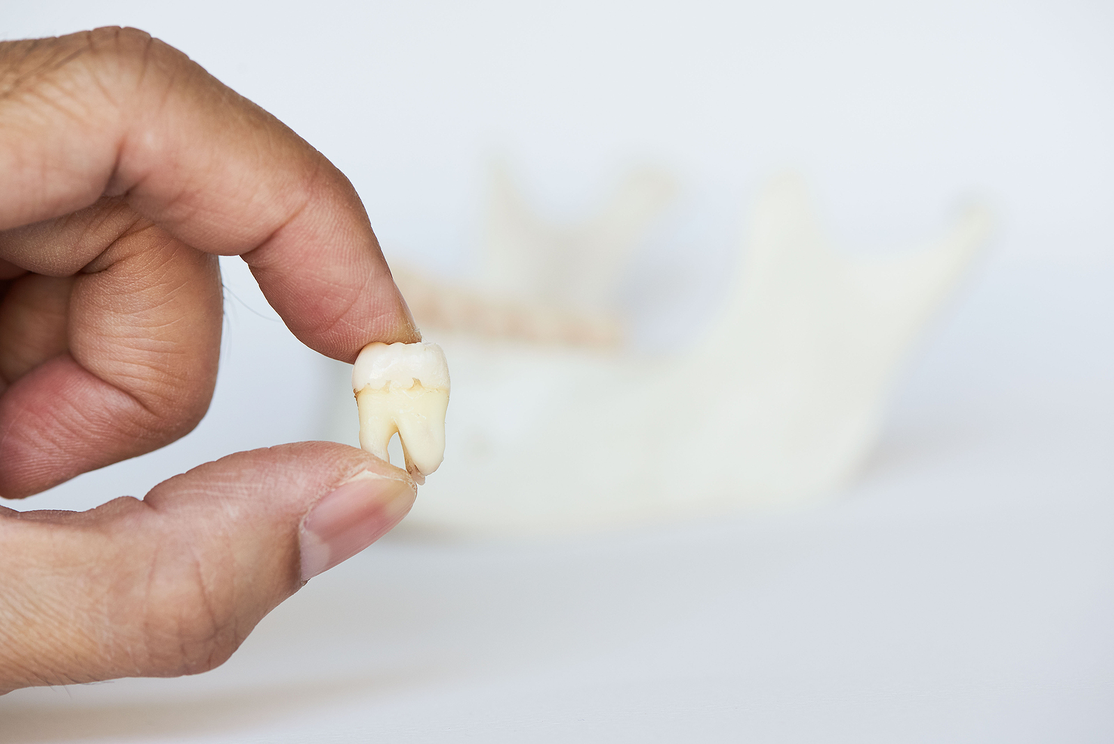 Wisdom Tooth Extraction in Suwanee, GA
