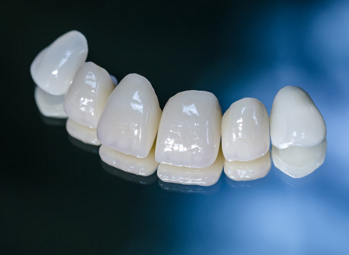 All You Need to Know About Emax Crowns | Tijuana Dental Studio Tijuana ...